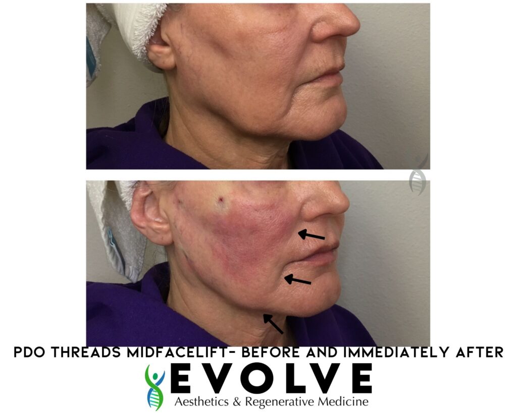 Morpheus8 vs. PDO threads - Evolve Aesthetics